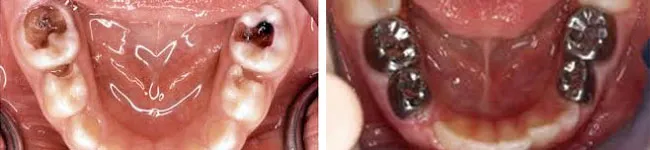Pediatric Dental Fillings Keene NH, Tooth Fillings Pediatric Dental Fillings Keene NH, Tooth Fillings